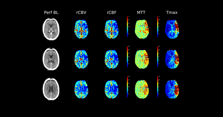 CT Perfusion Image Analysis Software for Stroke | RapidAI